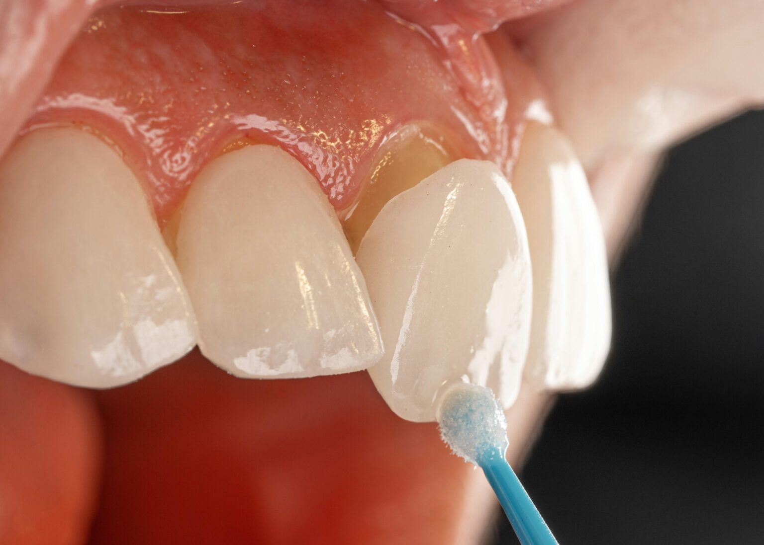 Laminate Veneers - Swissmed Dental